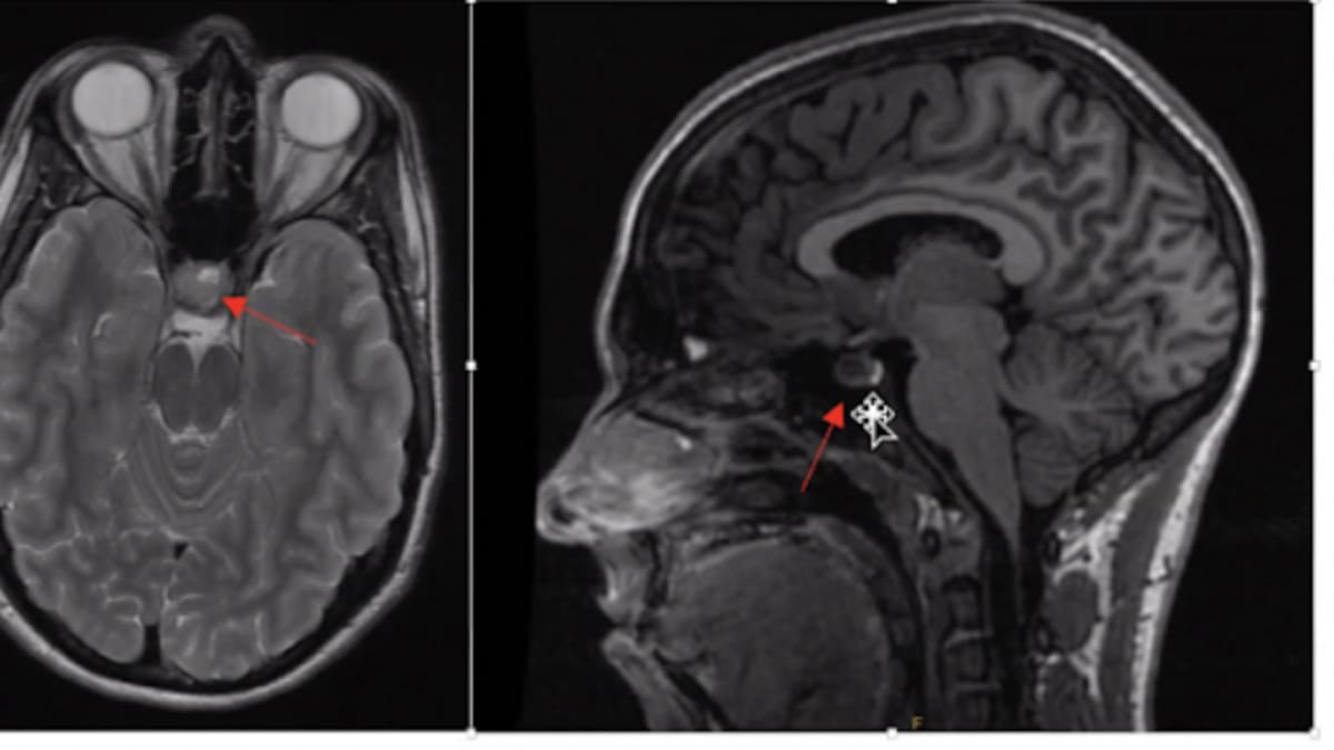 Medical Mysteries: For years she was told it was stress – a brain scan ...