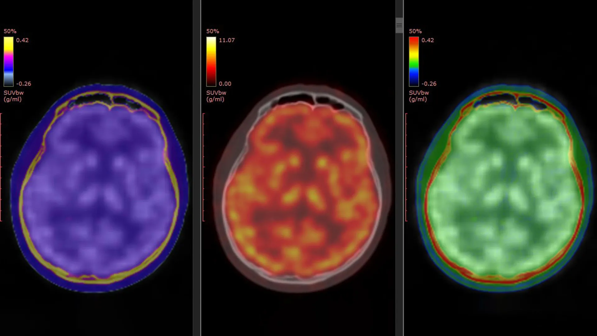 Brain scans reveal how ketamine quickly lifts severe depression ...